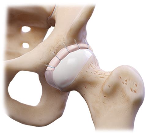 Hip Labral Reconstruction Surgery