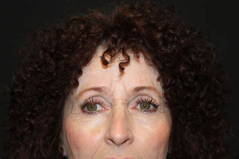 Breaking Down The Differences Between Botox And Daxxify Cape And Islands Plastic Surgery