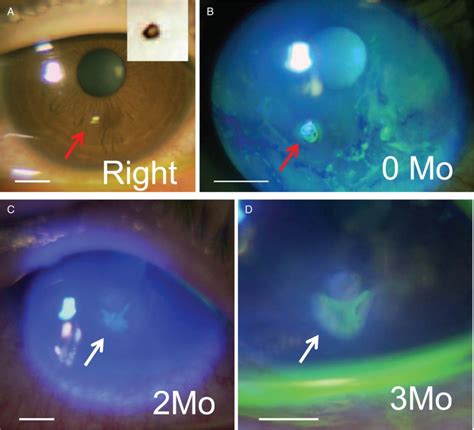 Clinical Course And Risk Factors Of Recurrent Corneal Erosion