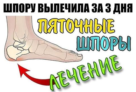 ШПОРУ ВЫЛЕЧИЛА ЗА 3 ДНЯ Поделюсь рецептами от пяточных шпор Прошлым Интересный контент в