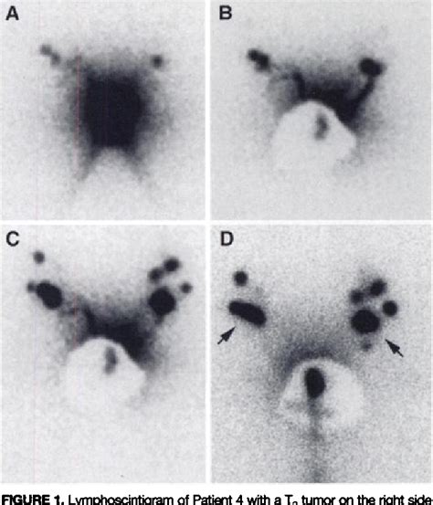 Figure 1 From Sentinel Lymph Node Identification With Technetium 99m Labeled Nanocolloid In
