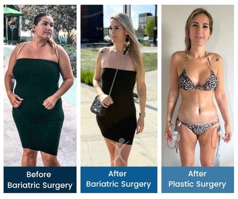 Plastic Surgery Body Before And After