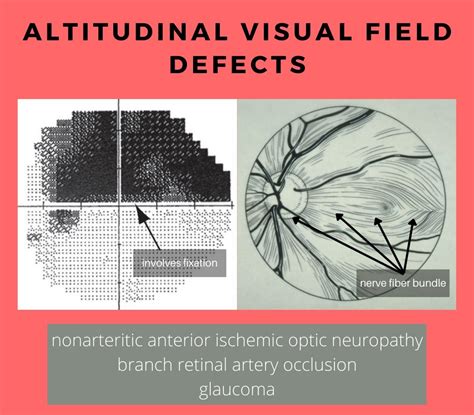 Branch Retinal Artery Occlusion Visual Field Defect