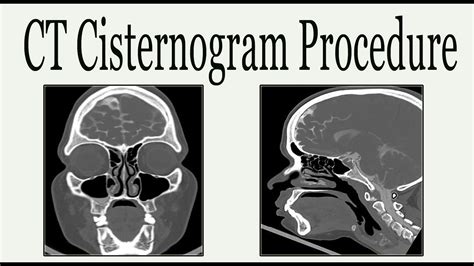 Ct Cisternogram Procedure Youtube