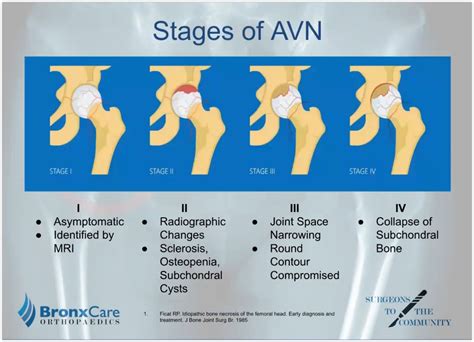 Hip Avascular Necrosis Osteonecrosis Avn Necrosis Of