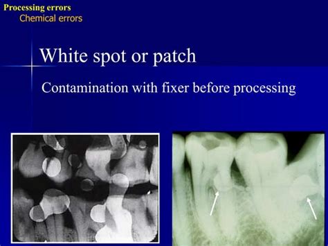 Radiographic Errors And Artifacts Pptx Photo Editing Software