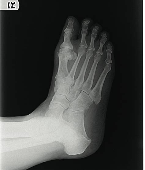 1st Mtpj Arthritis Hallux Rigidus A Comprehensive Review Mogo