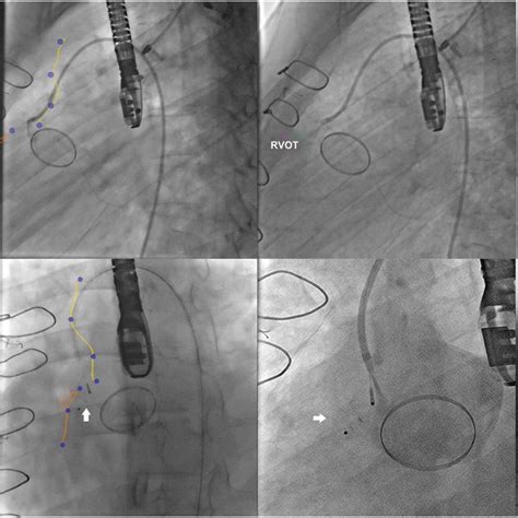 Computed Tomography Angiogramfluoroscopy Fusion Per‐procedural