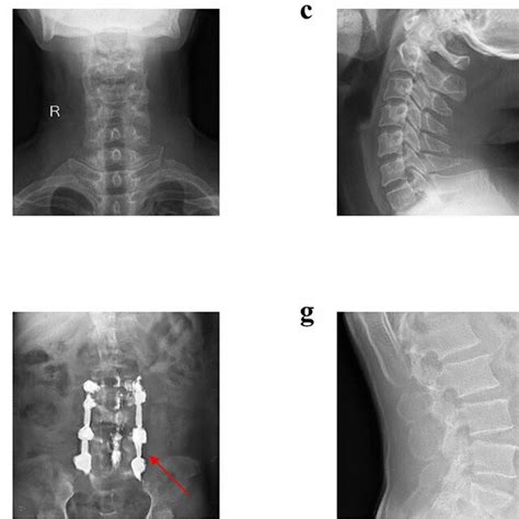 Gan Generated Synthetic Spine Radiographs Specified To Produce Normal