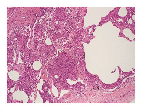 Histopathology Image Of A Rb Ild Specimen Demonstrates Diffuse Download Scientific Diagram