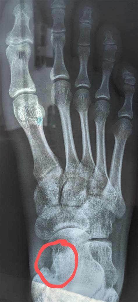 Does This Look Okay Is It Fractured R Xrays