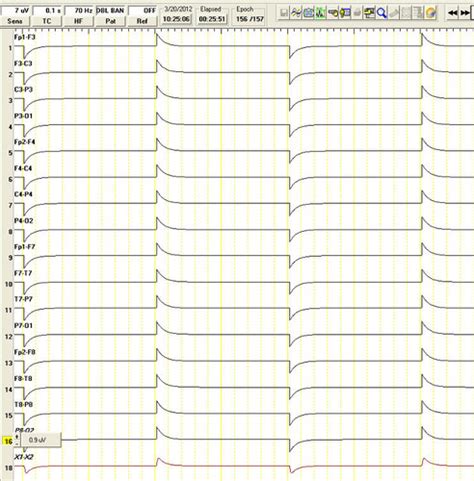 10 20 Montages Acns Guidelines Flashcards Quizlet