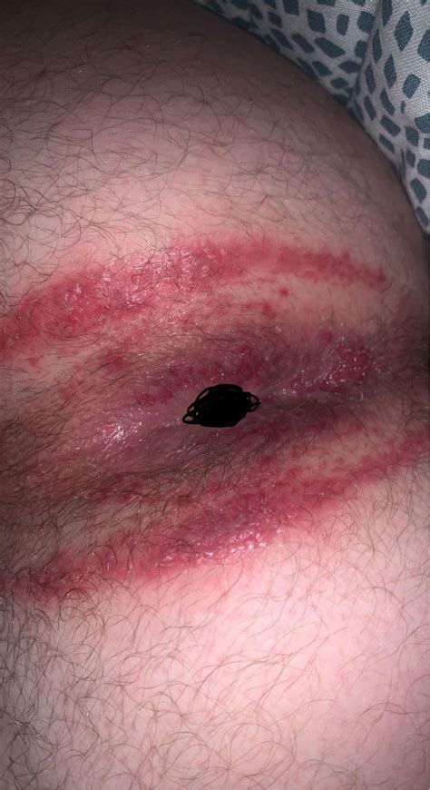 Blood On Condom Sex With Hooker Rstd