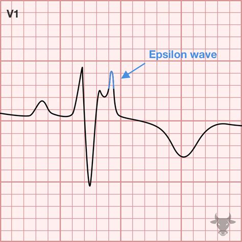 Epsilon Wave Arvc Clinical