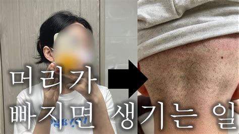 젊은 유방암 3기 탈모 과정과 필수팁 공개암 환자 브이로그 Youtube