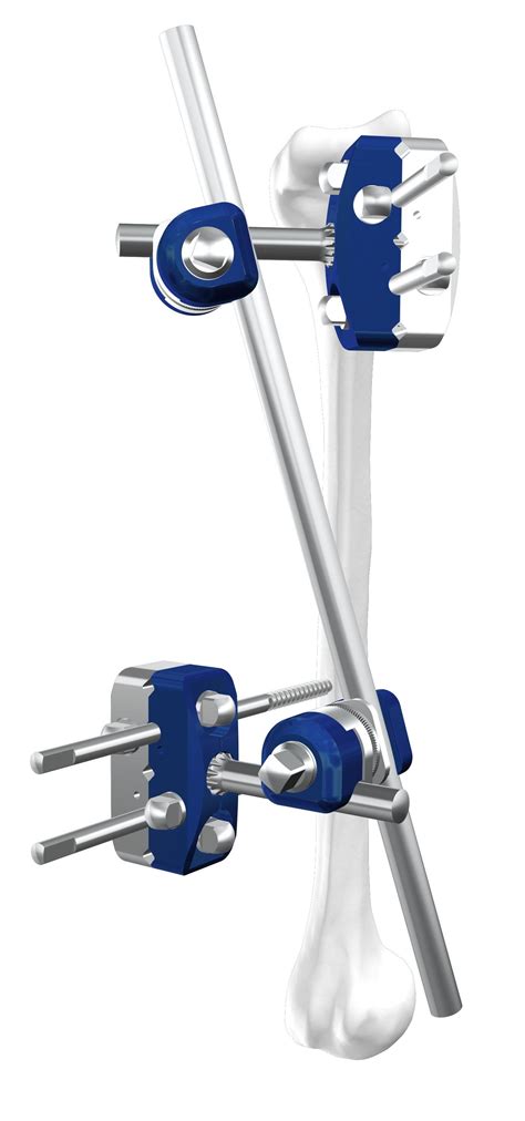 Orthopedic External Fixator Humerus External Fixation 8mm Medical And Surgical Equipment