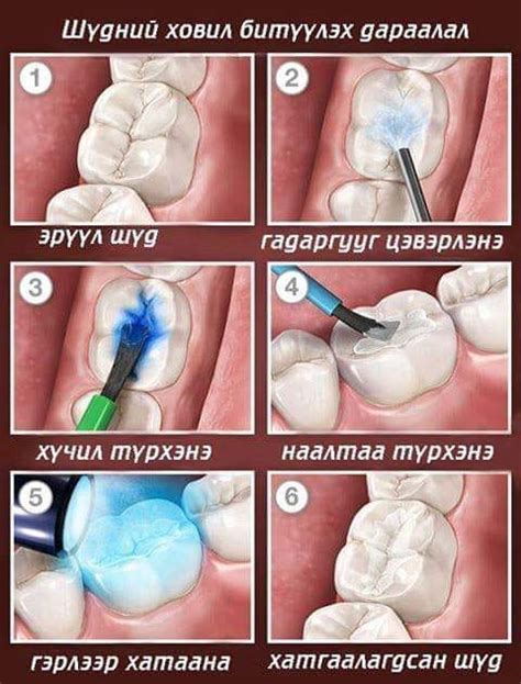 Сийлант цоорлоос хамгаалах ломбо Индранил Дентал Менежмент ХХК