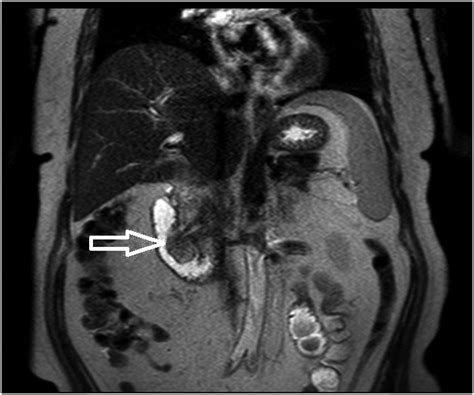 Mri Of The Patients Abdominal Organs After Temporary Biliary Stenting