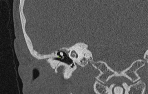 Radiopaedia Case Scutum Annotated CT Id 44495 Study 48168 NC Commons