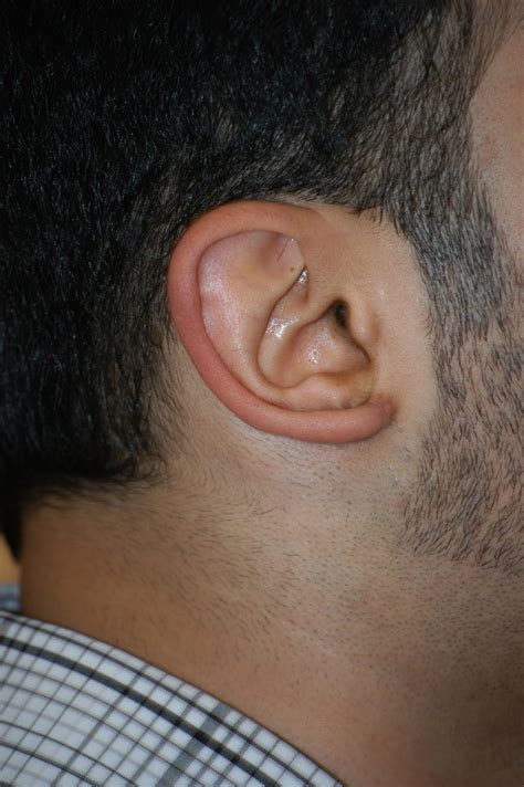Dr Bhupesh Vasisht Earlobe Reduction