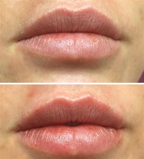 12 Syringe Lip Filler Before And After Filler Aesthetic