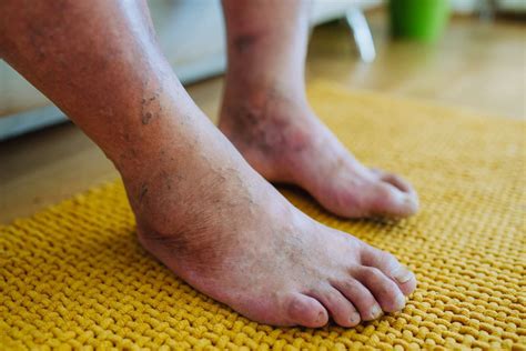 13 Facts About Diabetic Neuropathy