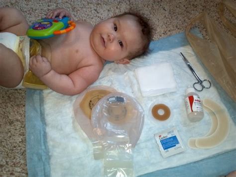 How To Apply An Infant Colostomy Bag Ia Journey