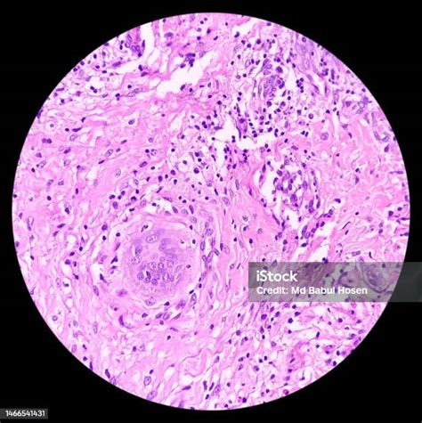항문 주위 농양 조직 이물질 육아종 현미경으로 육아종 상피 세포 클러스터를 보여줍니다 건강관리와 의술에 대한 스톡 사진 및 기타 이미지 Istock