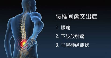腰间盘突出症 天津津南正大骨科医院