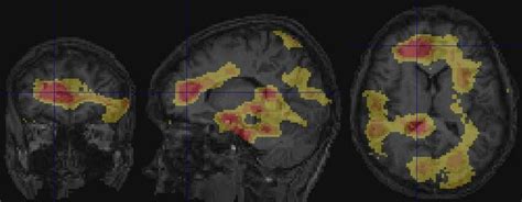 4 Example Of An Abnormal Perfusion Patterns Hot Color Coded Detected