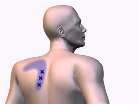 Trigger Points Mm Rhomboidei YouTube