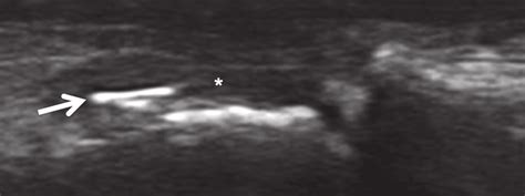 Foreign Body B Mode Image Of The Dorsal Pip Joint Showing A Synovitis Download Scientific