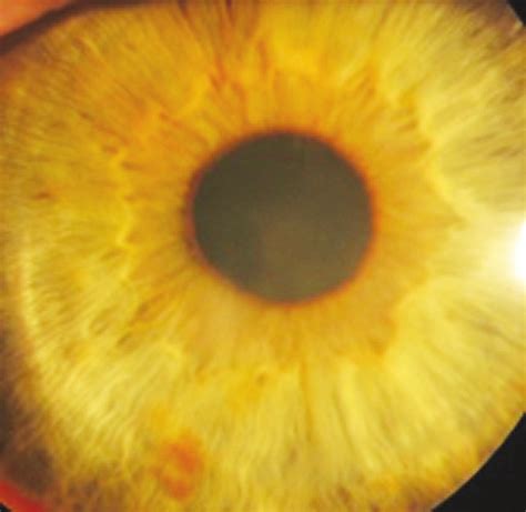 Postoperative Corneal Haze In A Group 2 Patient Рис 4 Download Scientific Diagram