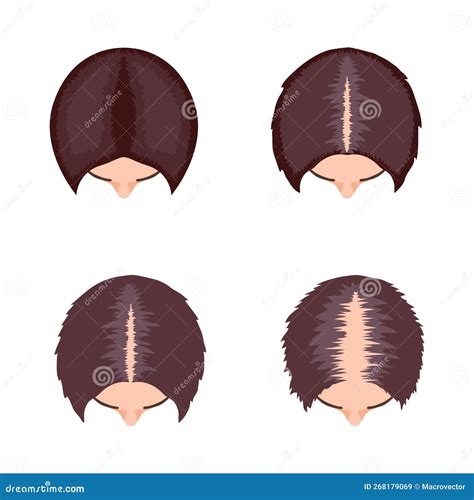 Alopecia Stages Set Hair Loss Balding Process Male Vector