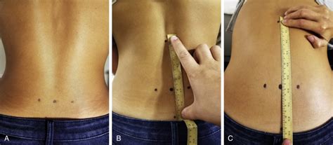 Sacral Dimple In Women