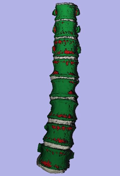 Challenge Segment A Spine NAMIC Wiki