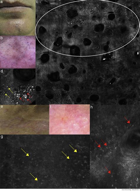 Reflectance Confocal Microscopy For Inflammatory Skin Diseases Actas