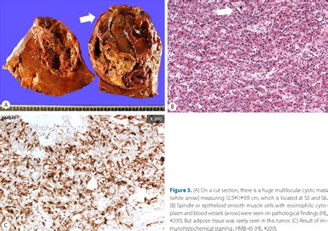 Figure 3 From A Case Of Ruptured Hepatic Angiomyolipoma In A Young Male