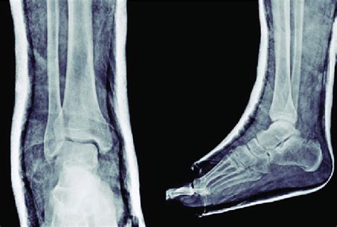 Radiography Of The Right Ankle Post Reduction Of Talus Dislocation Download Scientific Diagram