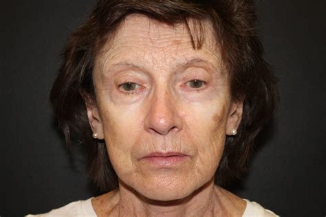 Pico Genesis Before After Photos Cape Girardeau MO Heart Land