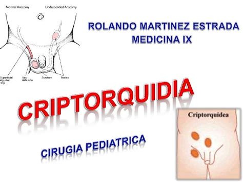 Criptorquidia