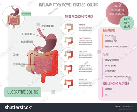 Infographic About Ulcerative Colitis Types Symptoms Stock Vector Royalty Free 2301165155