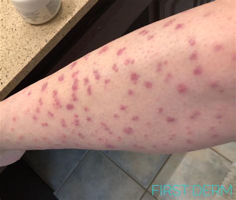 Ecchymosis Vs Petechiae