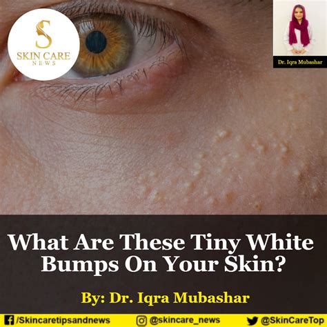 What Are These Tiny White Bumps On Your Skin