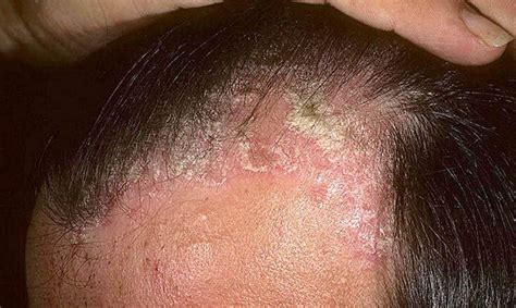 Signs Of Scalp Psoriasis