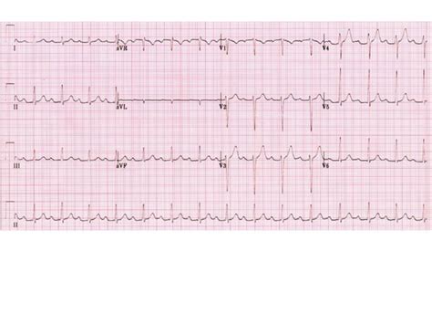 Ecg Lecture Sinus Arrest Sinoatrial Exit Block Av Block And Escape Rhythms Ppt Heart And