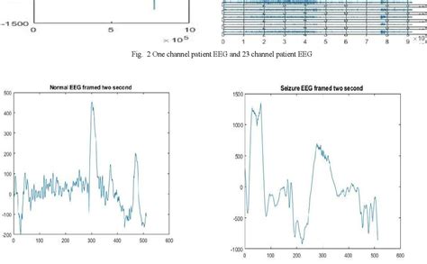 Figure 1 From Wavelet Based Detection Of Epileptic Seizures Using Scalp