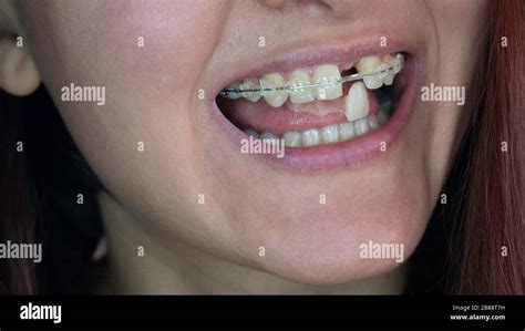A Womans Smile Smile Without Upper Left Unit Teeth Tooth Model With Metal Wire Dental Brace