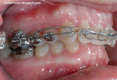 Orthodontic Corner Class Ii Div 2 Deep Bite Where Is The Limit