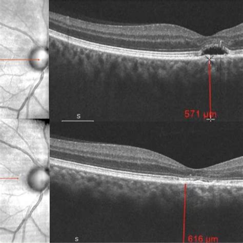 Image Processing Method Used To Investigate The Choriocapillaris Flow